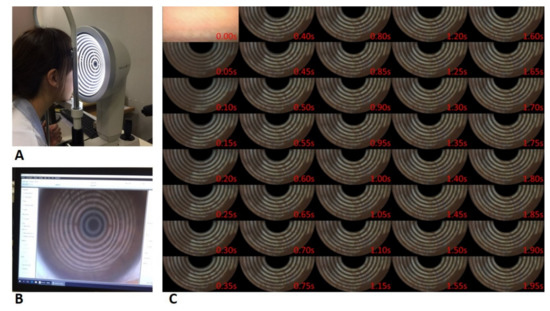 Determination of Tear Lipid Film Thickness Based on a Reflected Placido ...