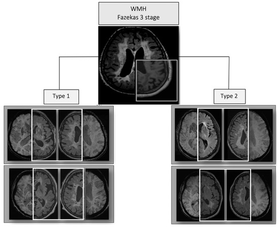 MRI Types of Cerebral Small Vessel Disease and Circulating Markers of ...