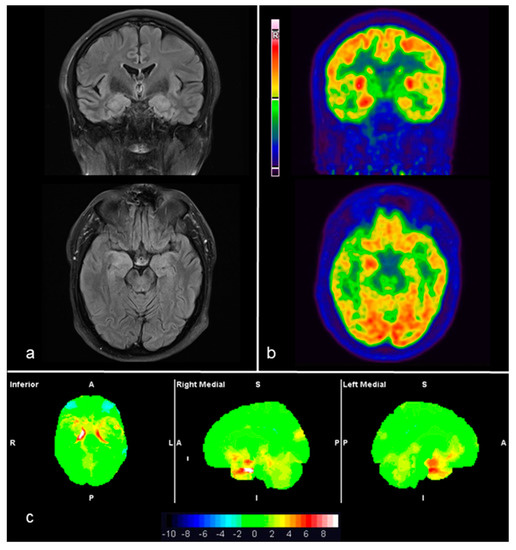 18F-FDG-PET Imaging Patterns in Autoimmune Encephalitis: Impact of ...