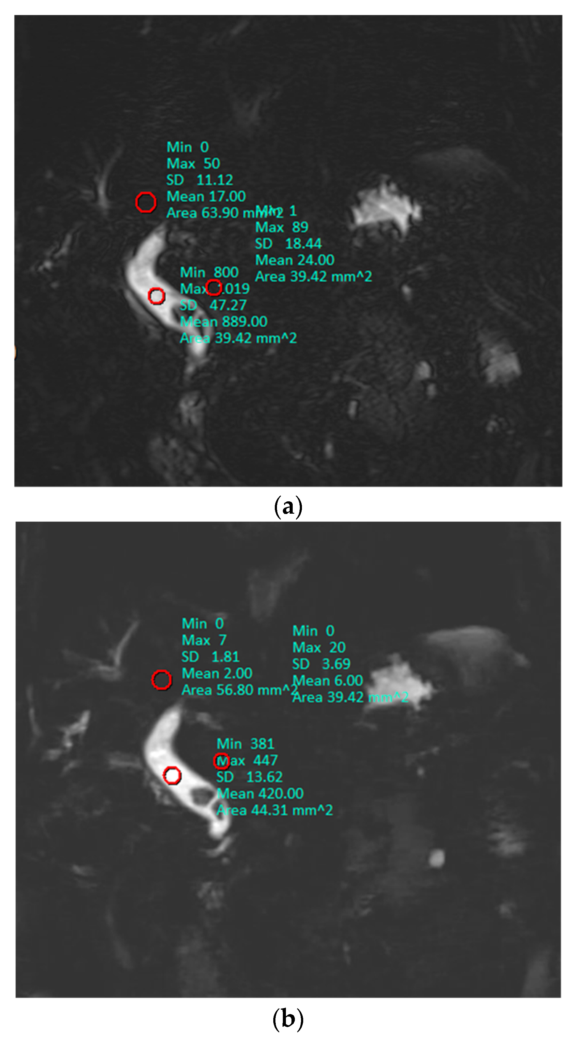 Optimized Breath-Hold Compressed-Sensing 3D MR Cholangiopancreatography at 3T: Image Quality ...