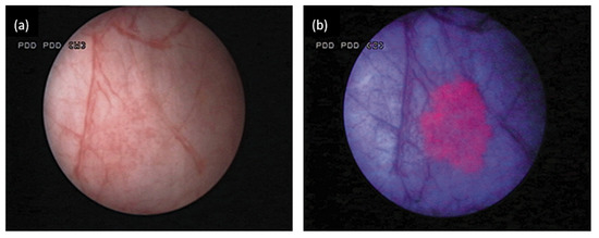 Shedding Light on Bladder Cancer Diagnosis in Urine