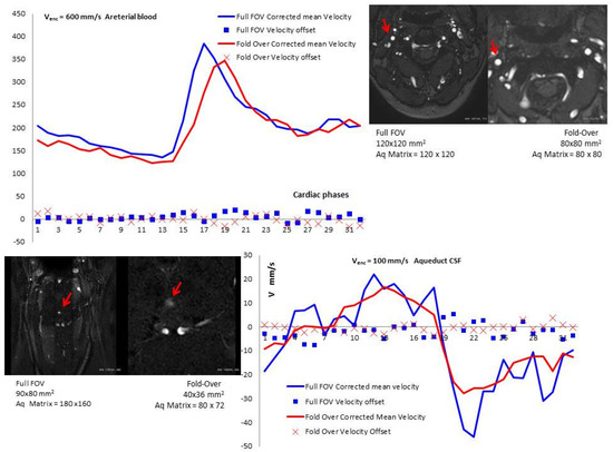 Fold-Over Oversampling Effects in the Measurements of Cerebral ...