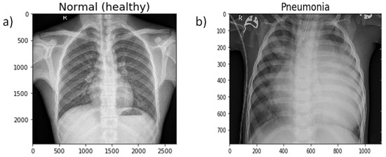 Efficient Pneumonia Detection in Chest Xray Images Using Deep Transfer ...