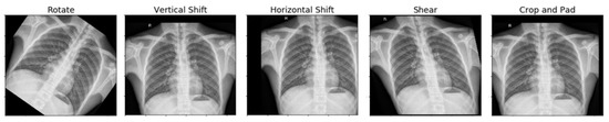 Efficient Pneumonia Detection in Chest Xray Images Using Deep Transfer ...