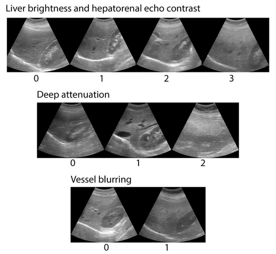 Accuracy of a Semi-Quantitative Ultrasound Method to Determine Liver ...