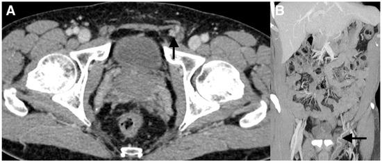 Ultrasound-Guided Percutaneous Antegrade Varicocele Embolization with ...