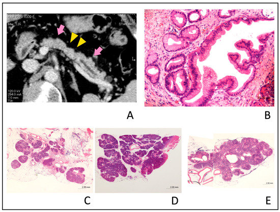 Partial Pancreatic Parenchymal Atrophy Is a New Specific Finding to ...