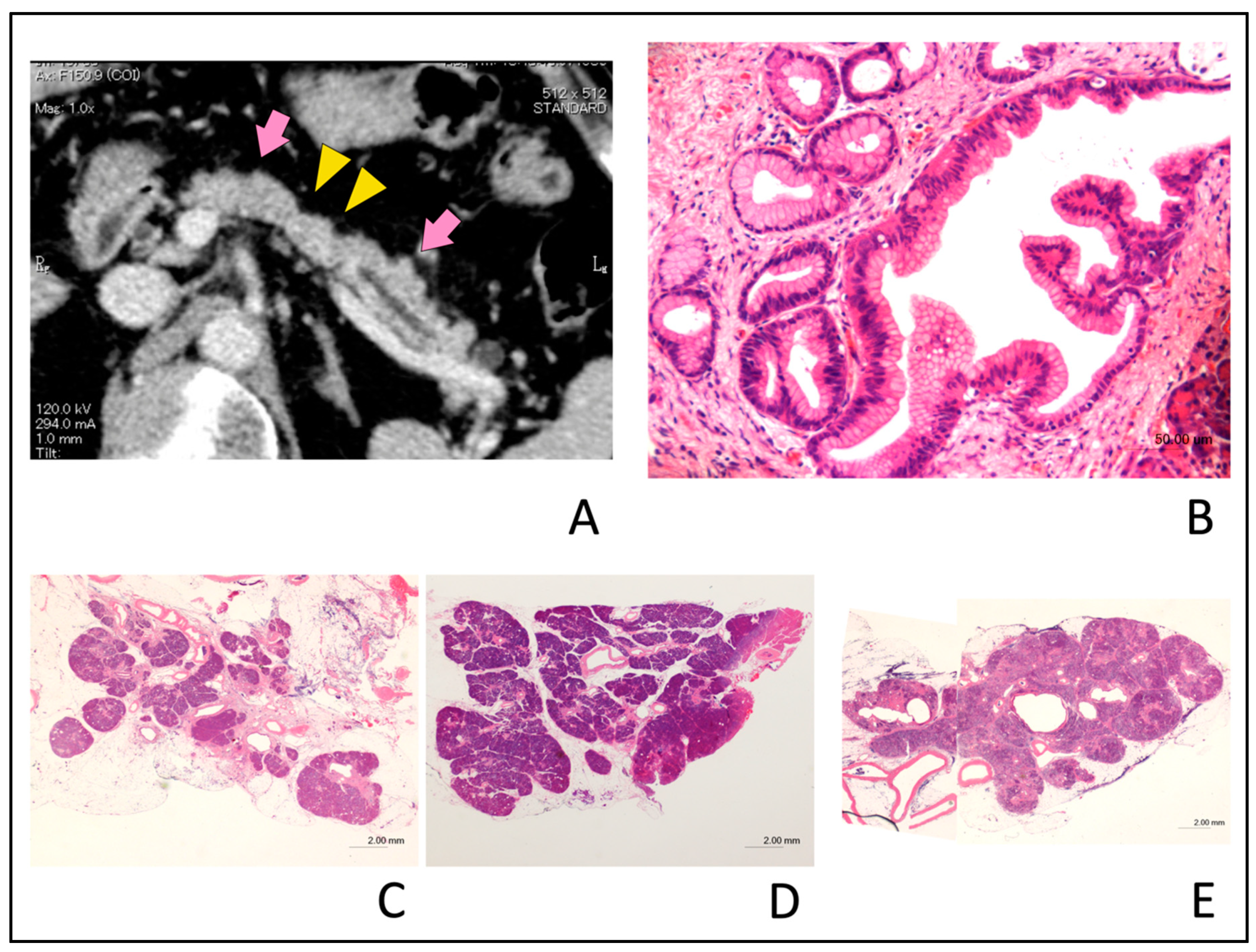 Partial Pancreatic Parenchymal Atrophy Is a New Specific Finding to Diagnose Small Pancreatic ...