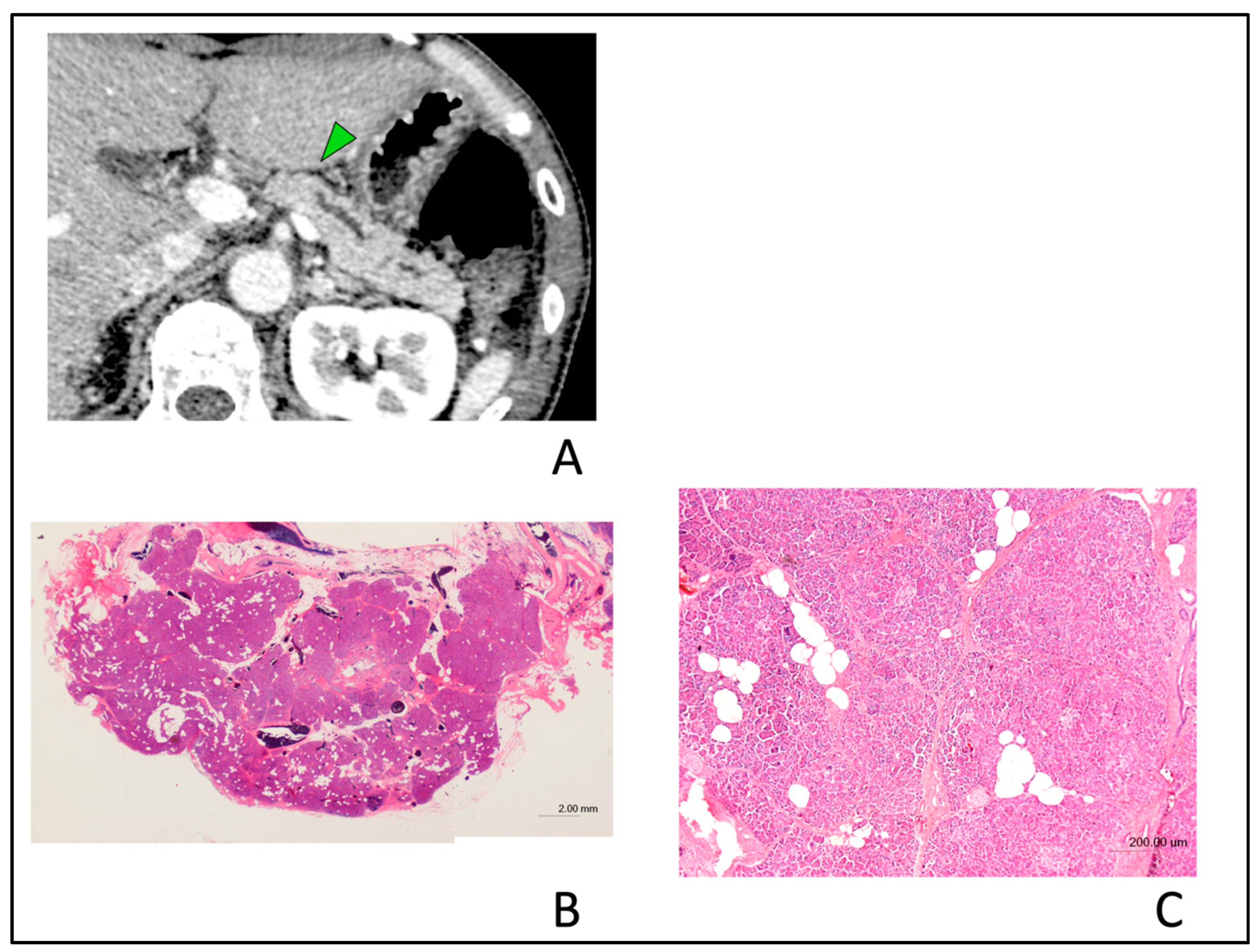 Parenchymal Atrophy