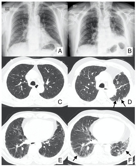 Complications in Idiopathic Pulmonary Fibrosis: Focus on Their Clinical ...