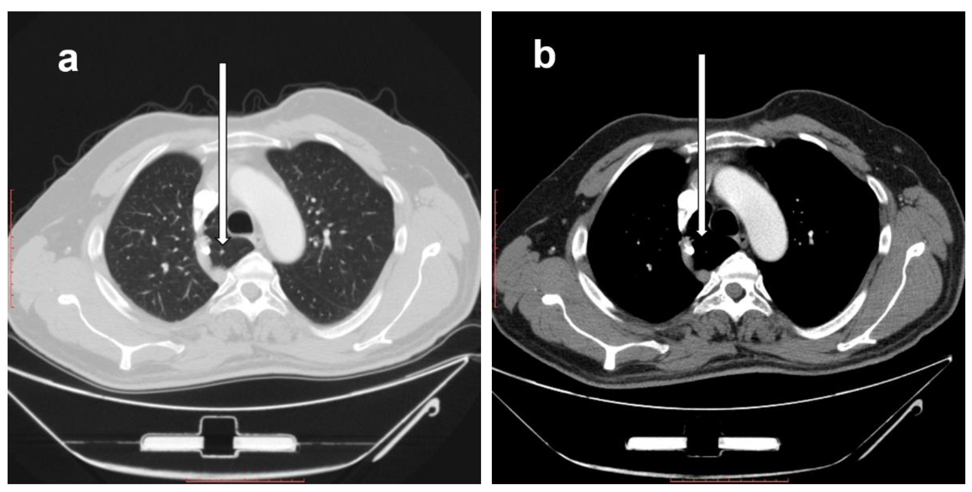 Diagnostics Free Full Text Azygos Lobe Prevalence Of An Anatomical