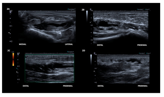 Intramuscular Ganglion Cyst of the Flexor Hallucis Brevis Secondary to ...