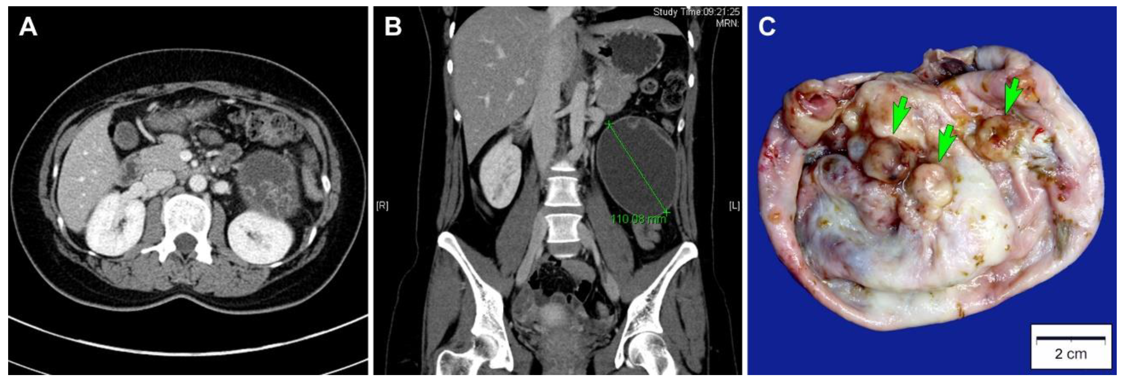 Primary Retroperitoneal Mucinous Carcinoma with Carcinosarcomatous Mural Nodules: A Case Report ...