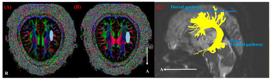 Relationship between Visual Perception and Microstructural Change of the Superior Longitudinal ...