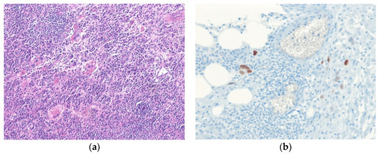 Retroperitoneal Sarcomas: An Update on the Diagnostic Pathology Approach