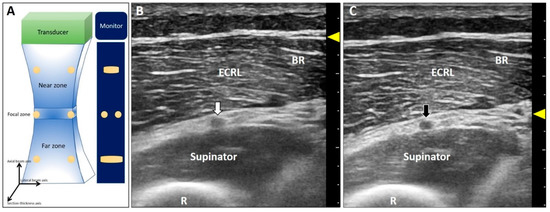 Artifacts in Musculoskeletal Ultrasonography: From Physics to Clinics