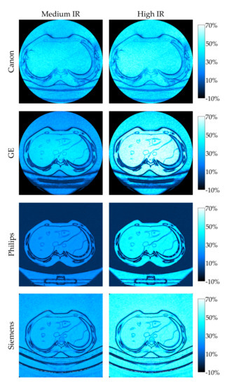 Spatial Distribution of Noise Reduction in Four Iterative Reconstruction Algorithms in CT—A ...