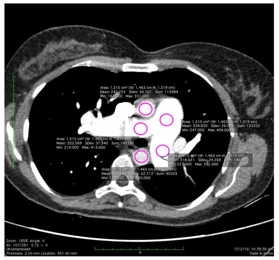 Establishment of CTPA Local Diagnostic Reference Levels with Noise ...