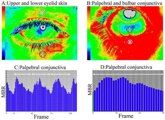 Correlation between Blood Flow and Temperature of the Ocular Anterior ...