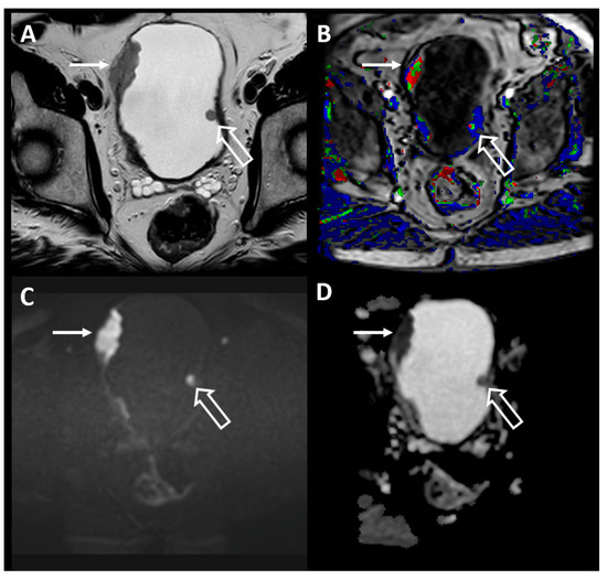 The Role of Imaging in Bladder Cancer Diagnosis and Staging