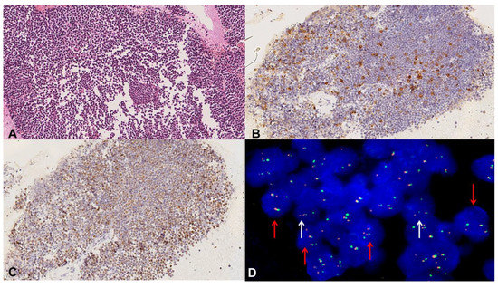Diagnosis of Hodgkin Lymphoma from Cell Block: A Reliable and Helpful ...