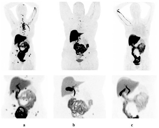 Image Quality and Interpretation of [18F]-FES-PET: Is There any Effect ...