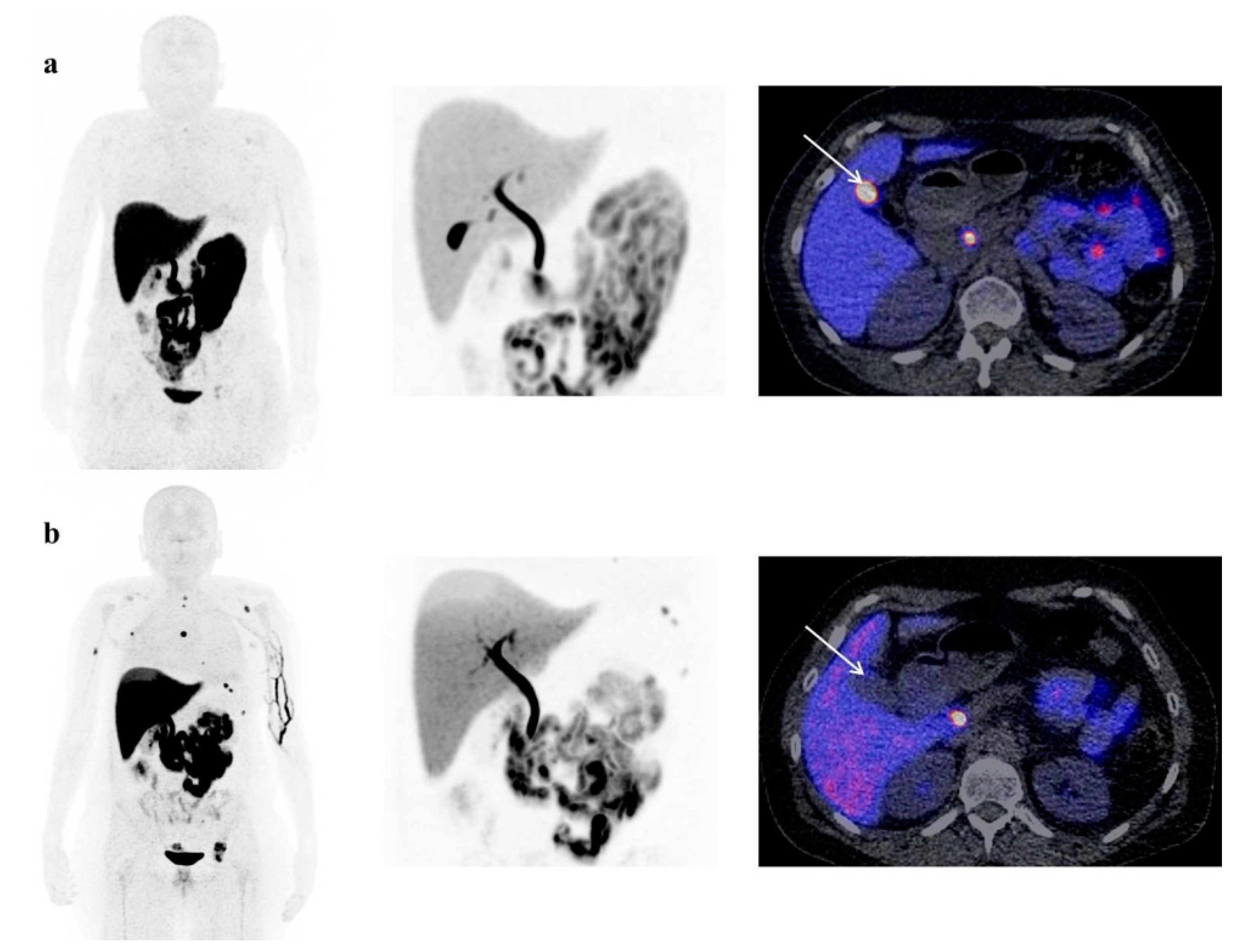 Image Quality and Interpretation of [18F]-FES-PET: Is There any Effect ...