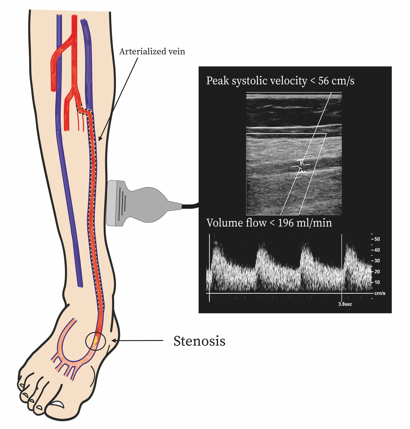 Diagnostics | Free Full-Text | Volume Flow and Peak Systolic Velocity ...