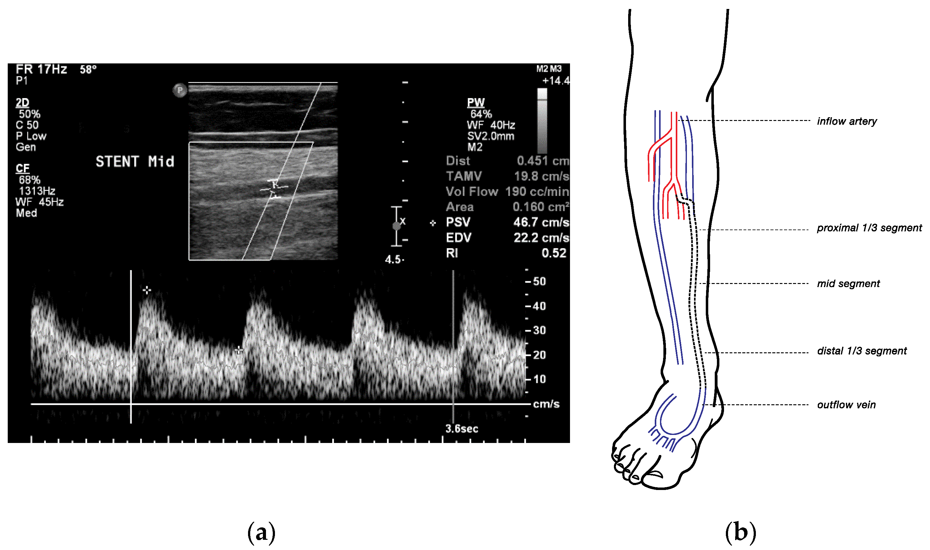 Volume Flow and Peak Systolic Velocity of the Arteriovenous Circuit in ...