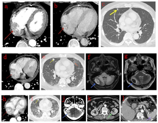 Clinical and Imaging Features of Primary Cardiac Angiosarcoma