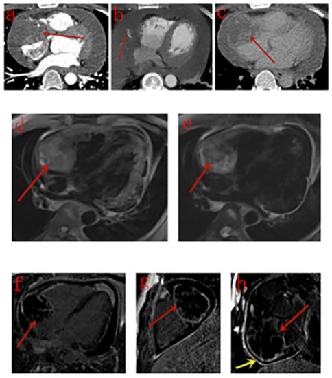 Clinical and Imaging Features of Primary Cardiac Angiosarcoma