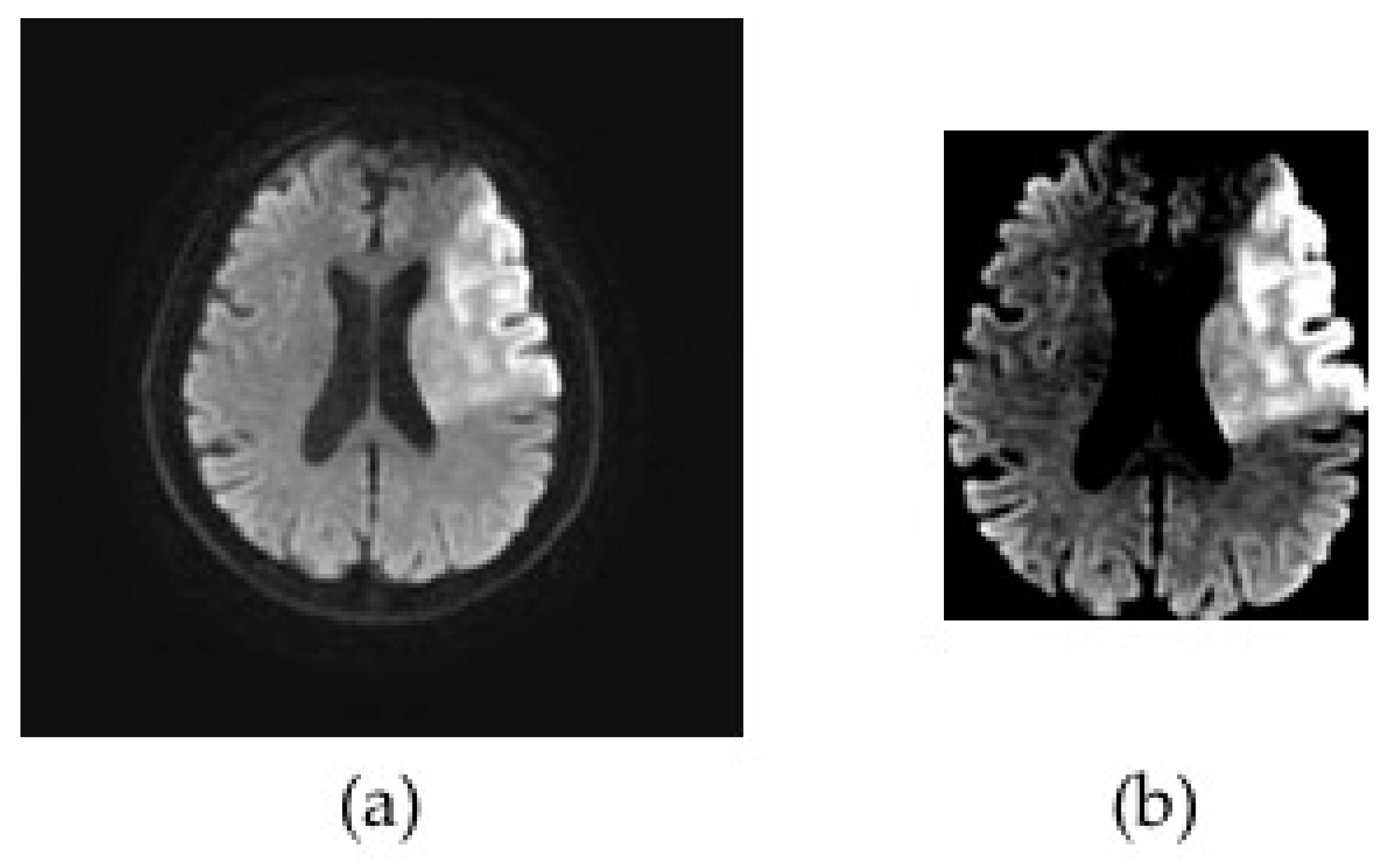 Automatic Assessment of ASPECTS Using Diffusion-Weighted Imaging in ...