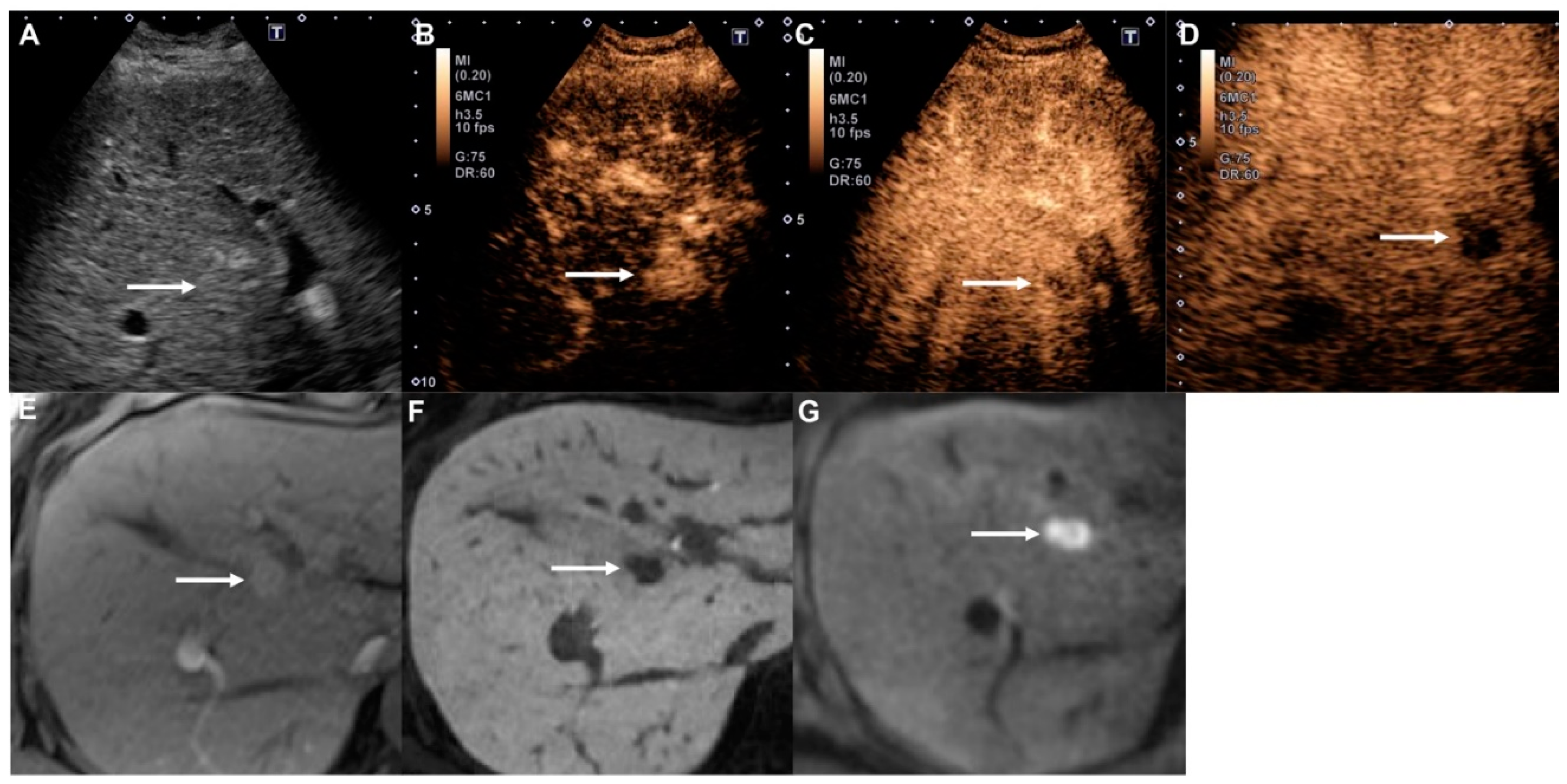 Usefulness of Modified CEUS LI-RADS for the Diagnosis of Hepatocellular ...
