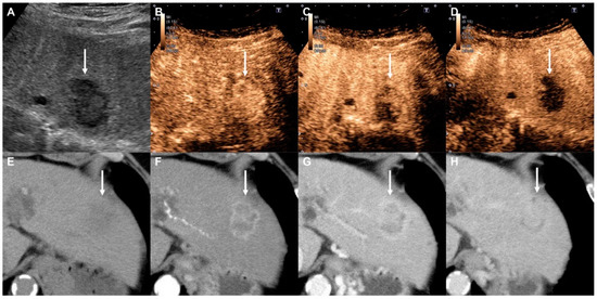 Usefulness of Modified CEUS LI-RADS for the Diagnosis of Hepatocellular ...