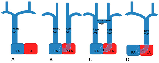 Persistent Left Superior Vena Cava with Absent Right Superior Vena Cava ...