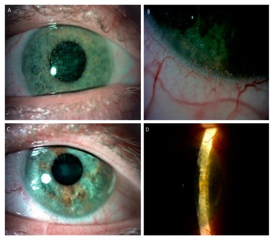 Ophthalmic Evaluation of Diagnosed Cases of Eye Cystinosis: A Tertiary ...