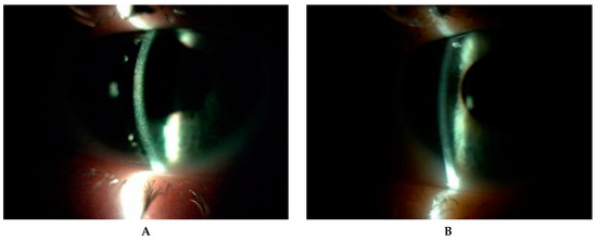 Ophthalmic Evaluation of Diagnosed Cases of Eye Cystinosis: A Tertiary ...