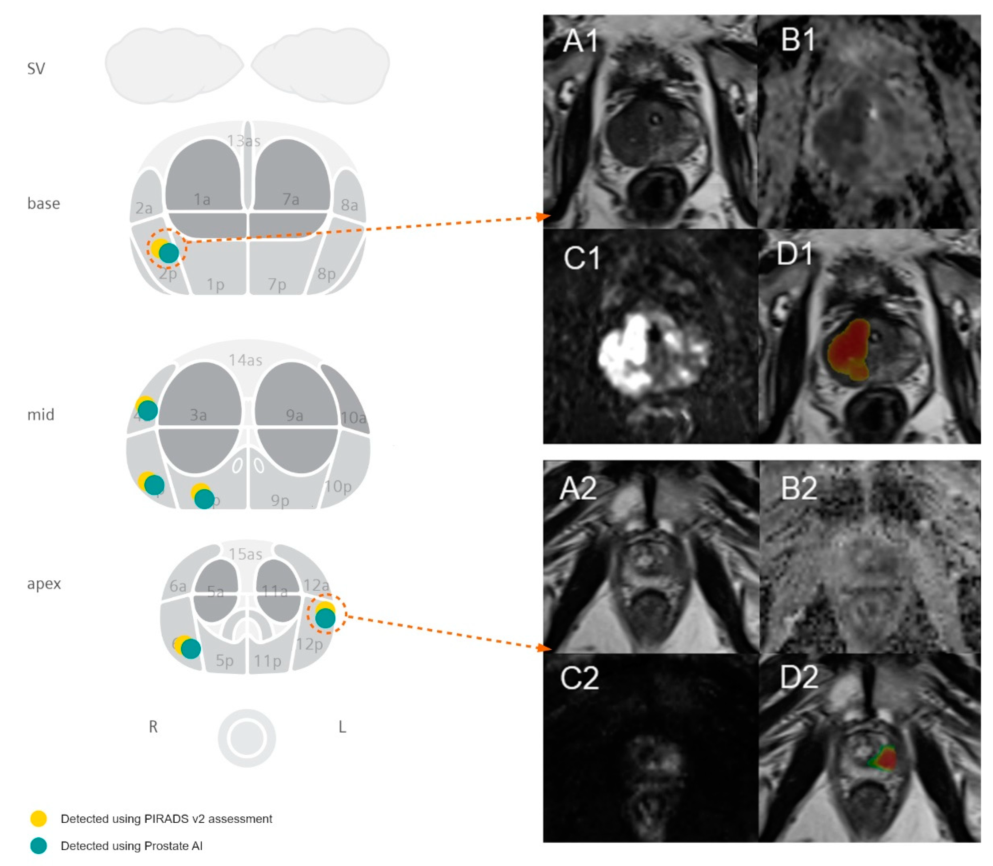 Autonomous Detection and Classification of PI-RADS Lesions in an MRI ...