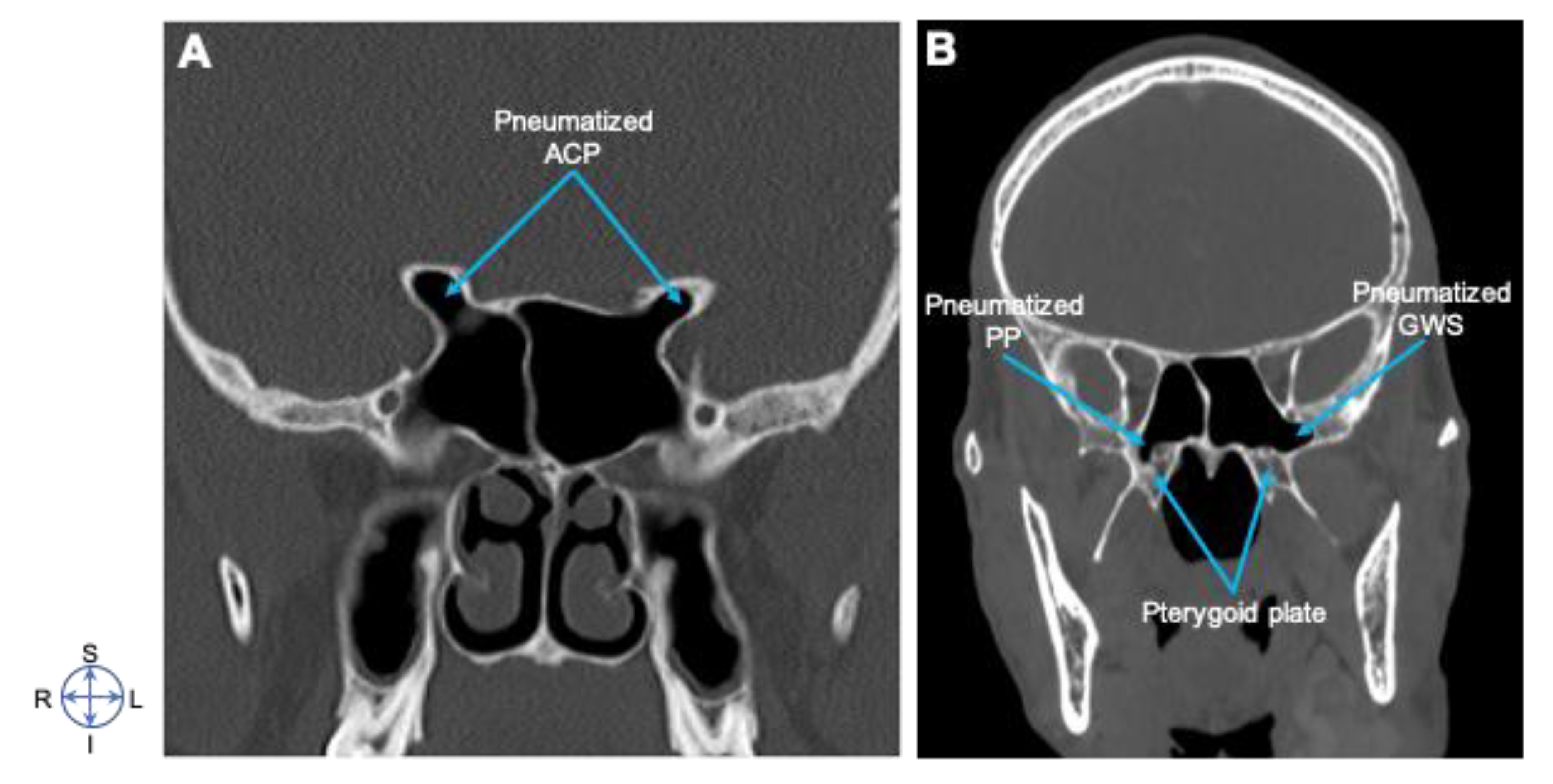 Diagnostics Free Full Text Anatomographic Variants Of Sphenoid