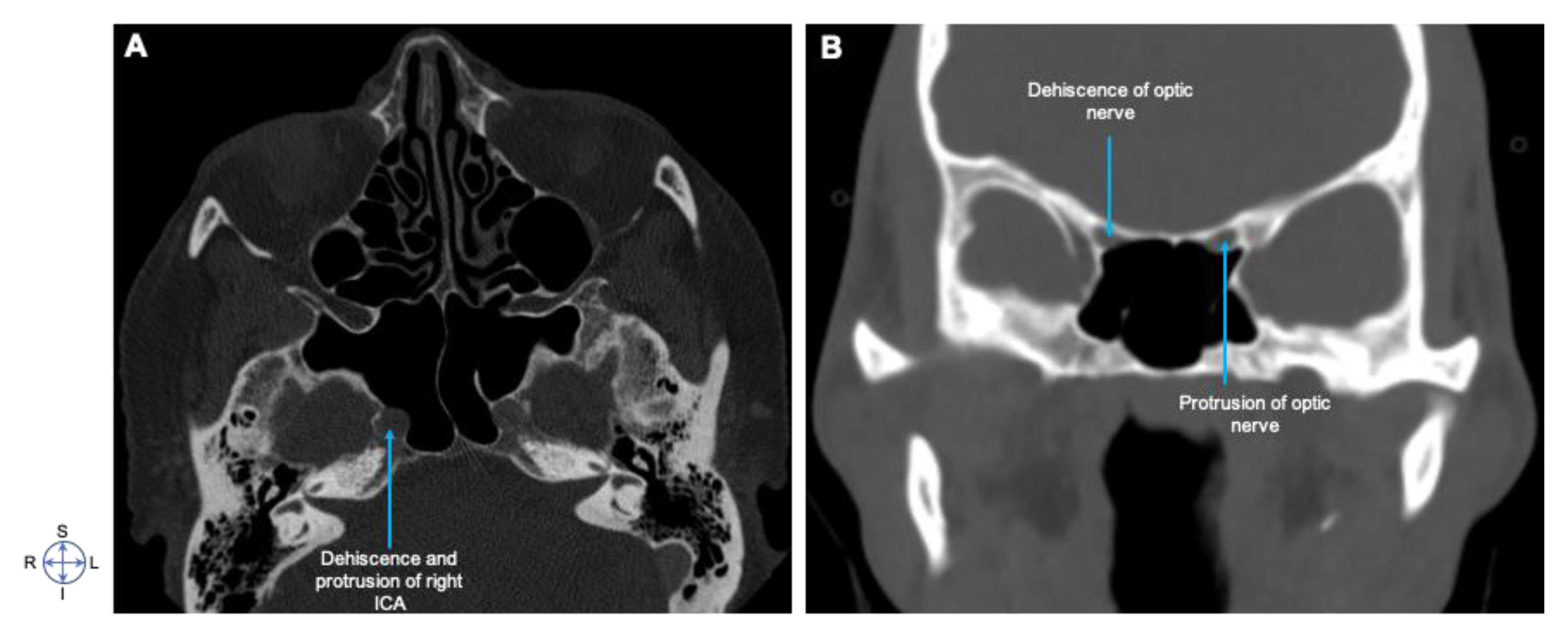 Diagnostics Free Full Text Anatomographic Variants Of Sphenoid