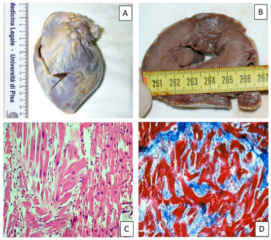 Post-Mortem Cardiac Magnetic Resonance for the Diagnosis of ...