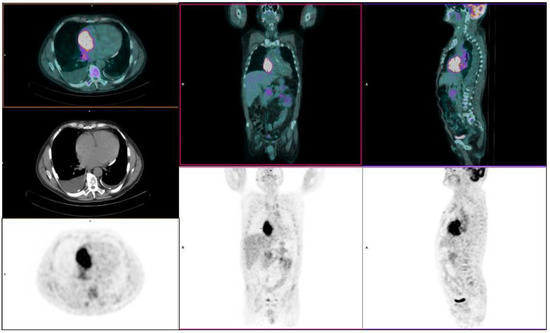 Right Atrium Mass Assessed with 18F-FDG PET/CT Scan Turns Out to Be an Uncommon Relapse of ...