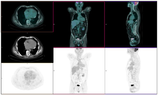 Right Atrium Mass Assessed with 18F-FDG PET/CT Scan Turns Out to Be an Uncommon Relapse of ...