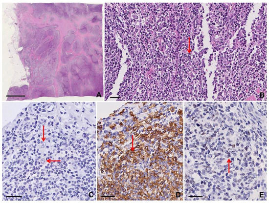 Diagnostics | Free Full-Text | Hodgkin Reed–Sternberg-Like Cells in Non ...