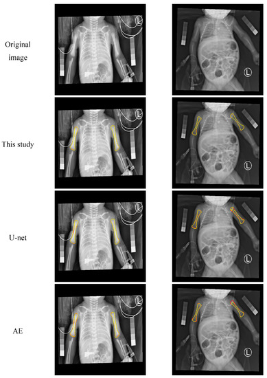 Convolutional Neural Network-Based Humerus Segmentation and Application to Bone Mineral Density ...