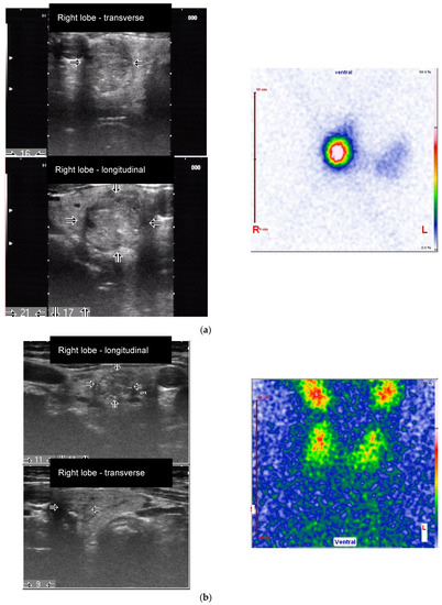 Ultrasound Assessment of Autonomous Thyroid Nodules before and after ...