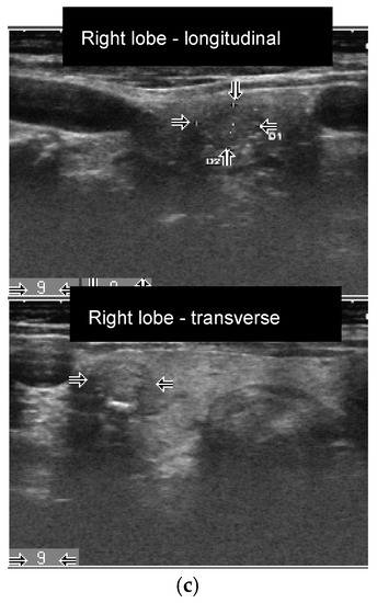 Ultrasound Assessment of Autonomous Thyroid Nodules before and after ...
