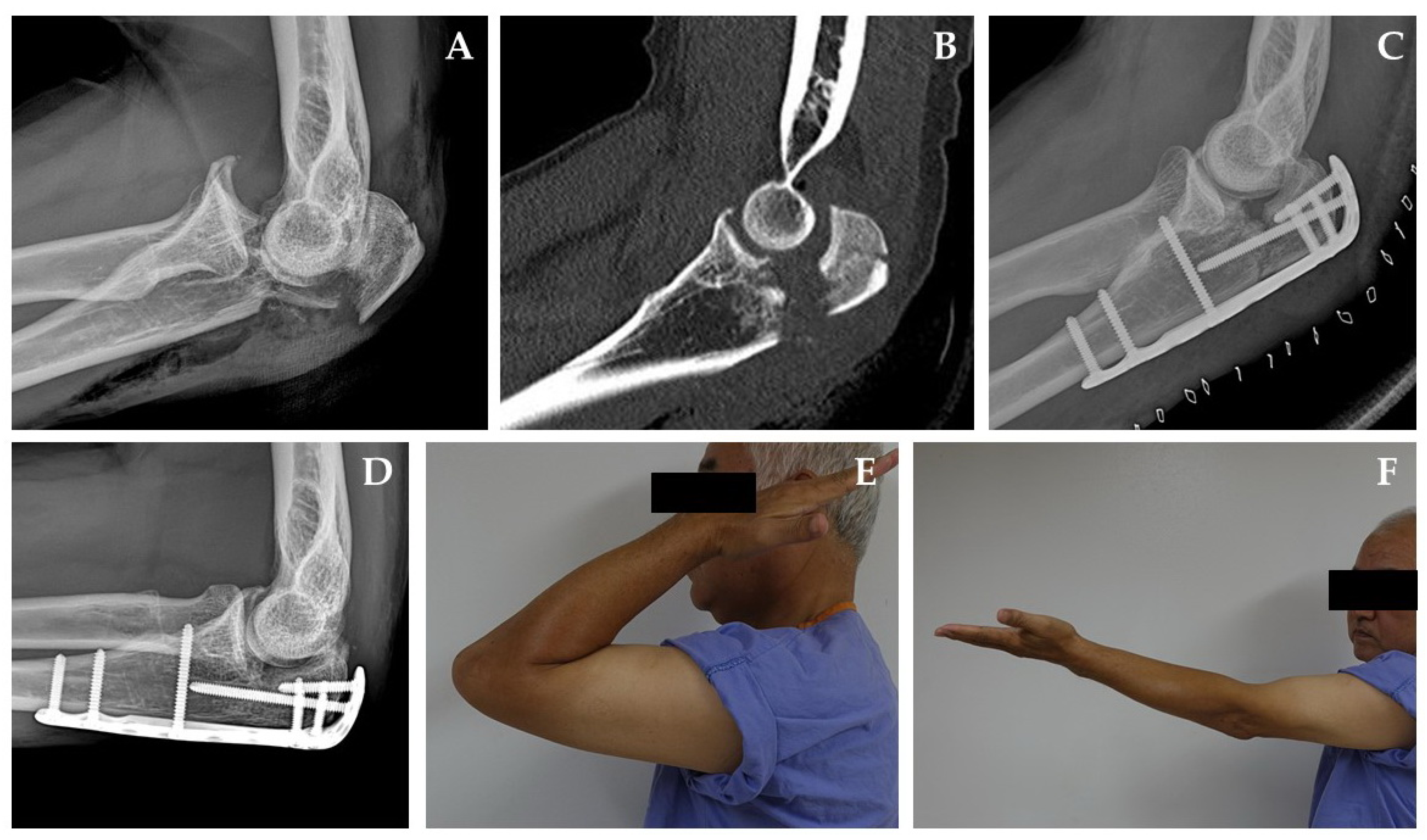 Diagnostics | Free Full-Text | Trans-Olecranon Fracture-Dislocations of ... Diagnostics | Free Full-Text | Trans-Olecranon Fracture-Dislocations of ...