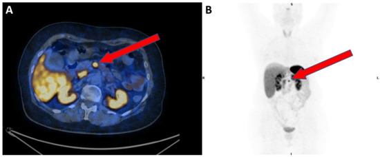 Role of PET/CT and Therapy Management of Pancreatic Neuroendocrine Tumors