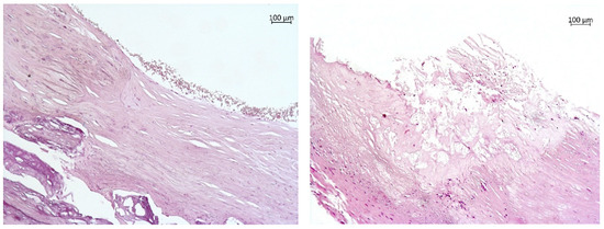The Influence of Calcification Factors and Endothelial-Dysfunction ...